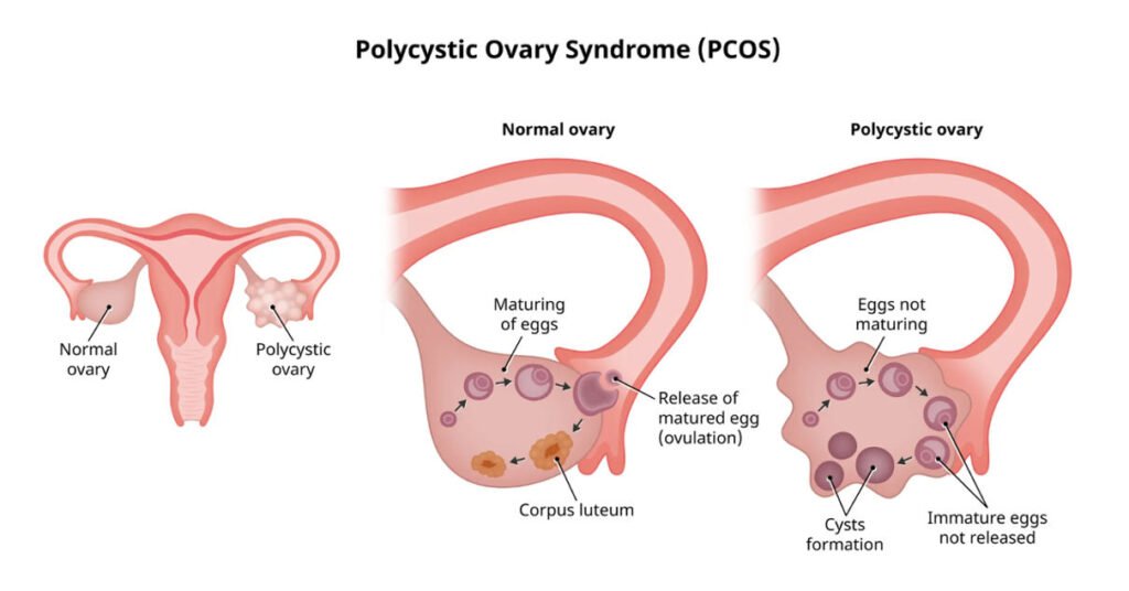 Your Ultimate Guide to Polycystic Ovary Syndrome (PCOS)