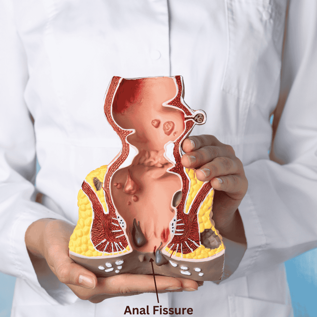 5 Critical Anal Fissure Symptoms In Women To Watch